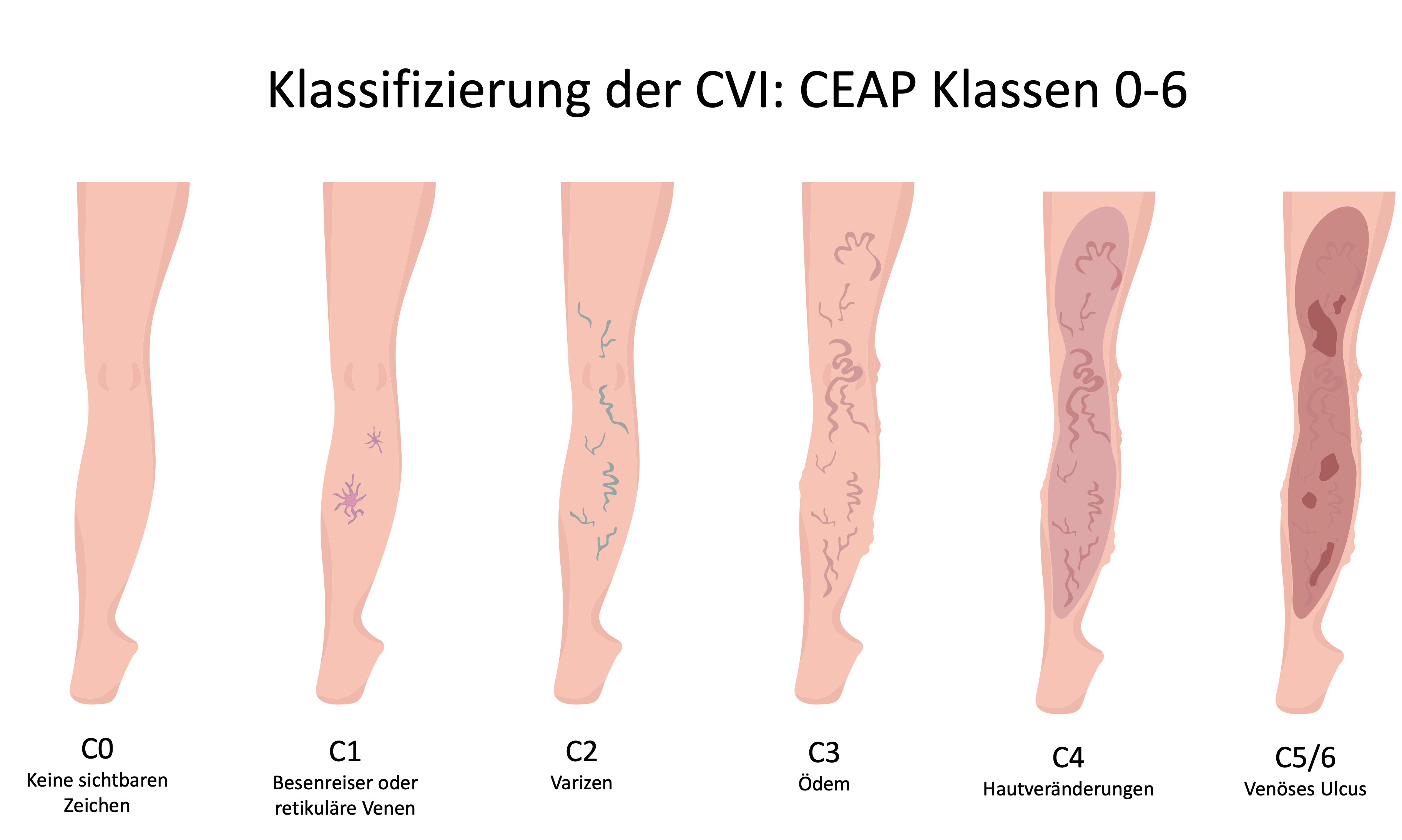 Venensystem und CVI - Vascular Academy | powered by SOT