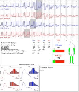 PVR – Pulse Volume Recording - Vascular Academy | powered by SOT