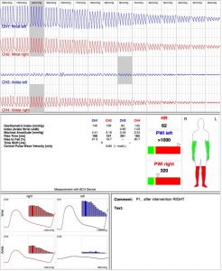 PVR – Pulse Volume Recording - Vascular Academy | powered by SOT
