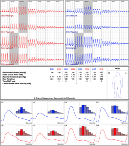 PVR – Pulse Volume Recording - Vascular Academy | powered by SOT