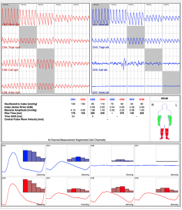 PVR – Pulse Volume Recording - Vascular Academy | powered by SOT