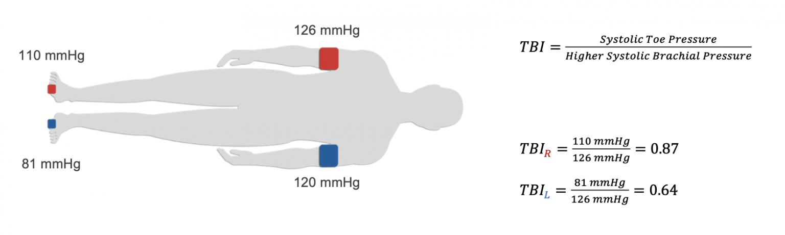 TBI – Toe Brachial Index - Vascular Academy | powered by SOT