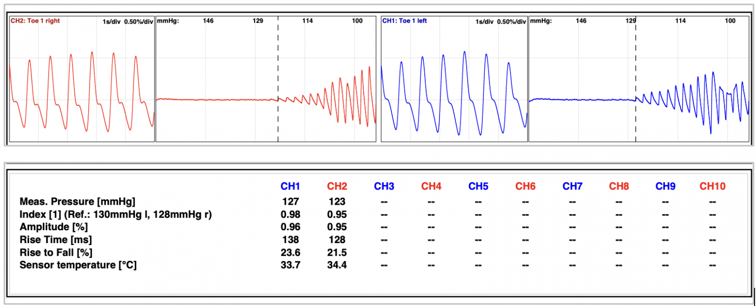 OAP – Optical Arterial Pressure - Vascular Academy | powered by SOT