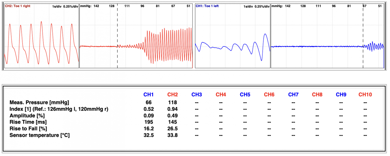 OAP – Optical Arterial Pressure - Vascular Academy | powered by SOT