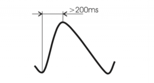 Pulse Wave Parameters - Vascular Academy | powered by SOT