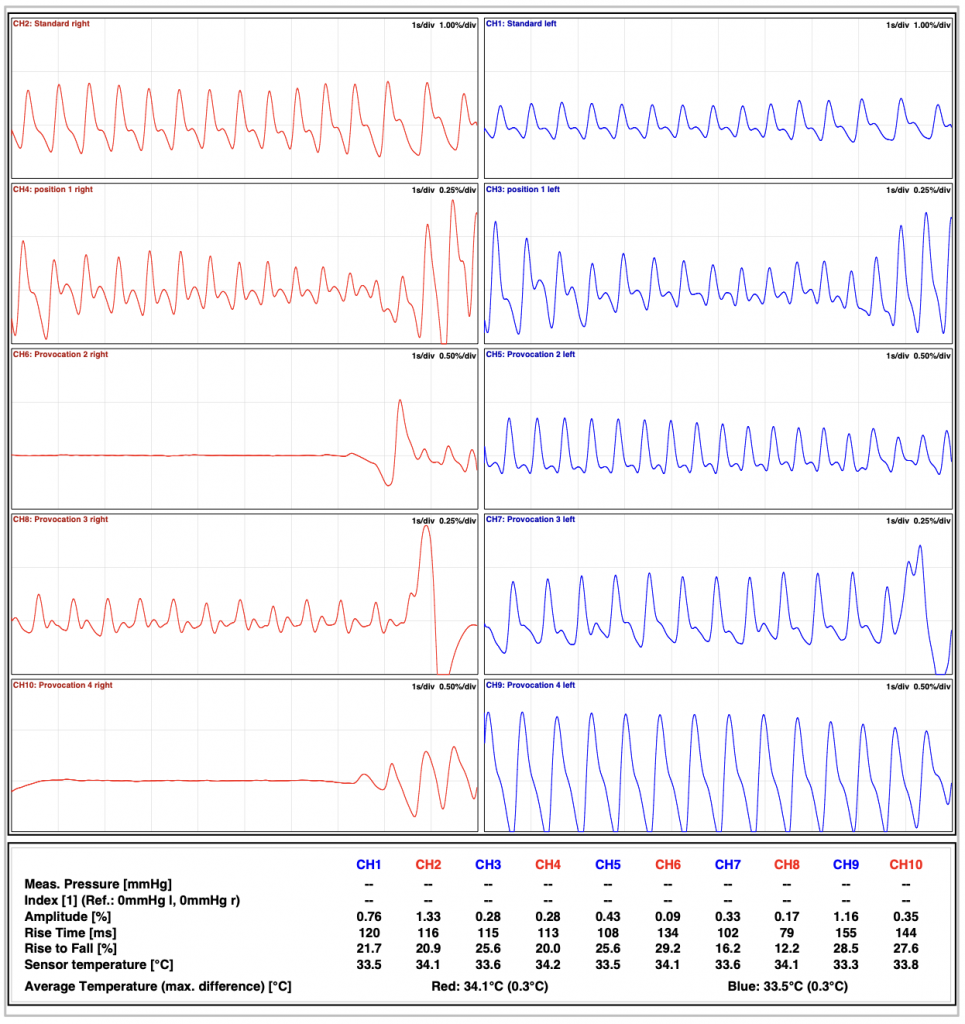 TOS-Test (Thoracic Outlet Syndrome) - Vascular Academy | powered by SOT