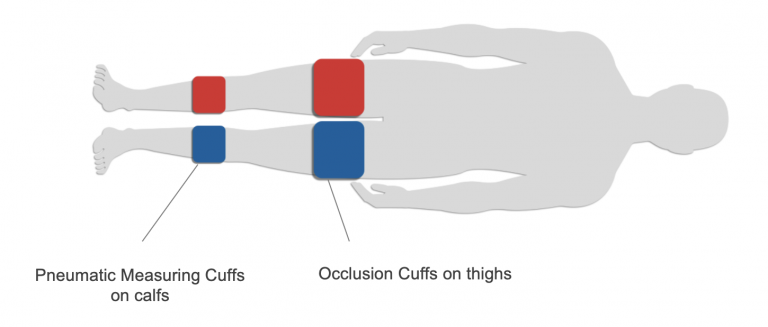 VOP – Venous Occlusion Plethysmography - Vascular Academy | powered by SOT